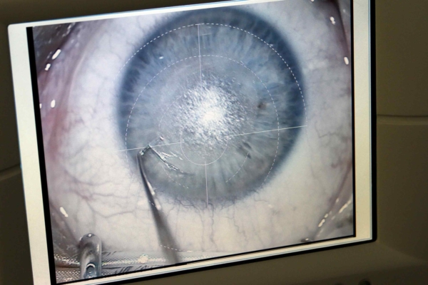 [Teil 2] Augen lasern mit der SMILE - Methode – Die Operation - InnenAussen