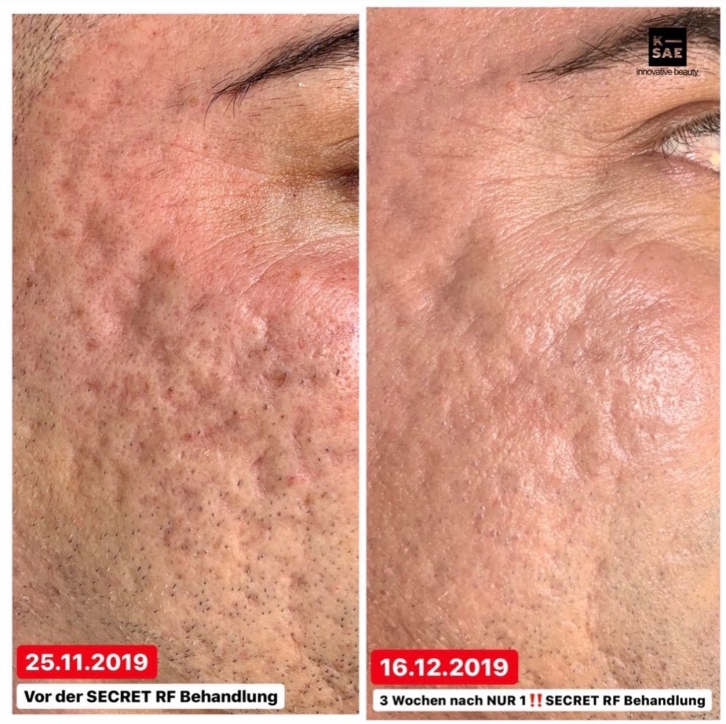 Luxus Radiofrequenz Gesicht Vorher Nachher Bilder